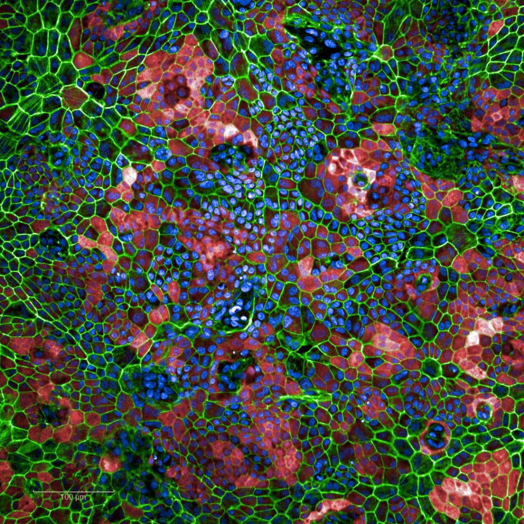 How Could Stem Cells Cure Blindness? Experts Discuss Their ...