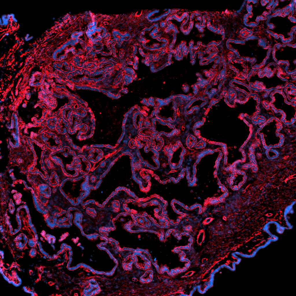 Directing Organoids Against Ovarian Cancer - New York Stem Cell Foundation